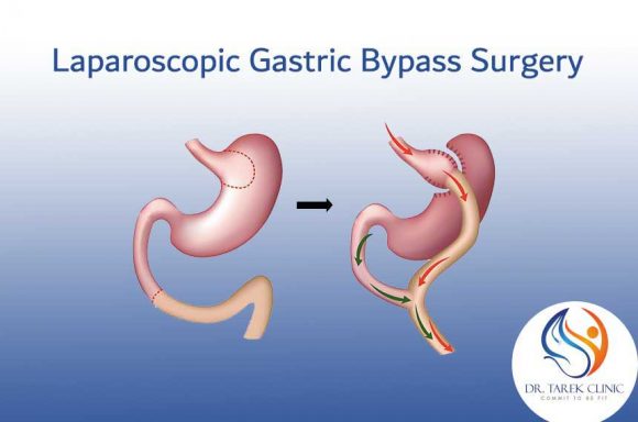 Mini-Gastric Bypass - Dr Tarek Abou Zeid